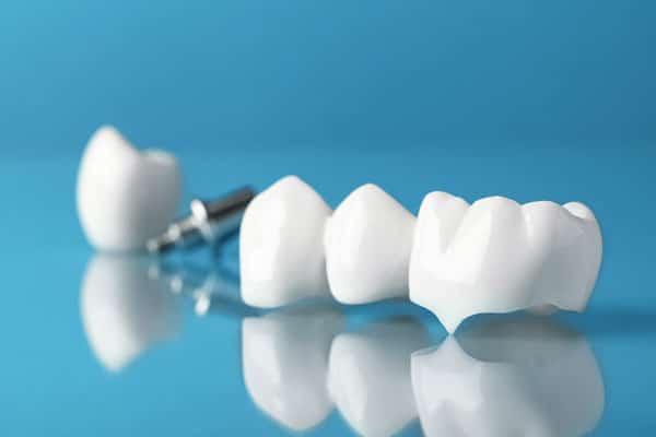 Crowns and Bridges in Shelton, WA | Shelton Dental Excellence